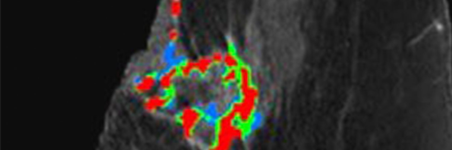 Breast Imaging and Intervention – Department of Radiology – UW–Madison